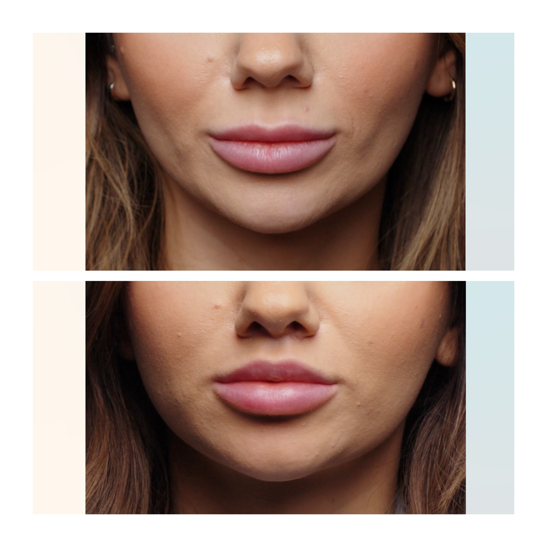 Face Surgeries- fi clinica