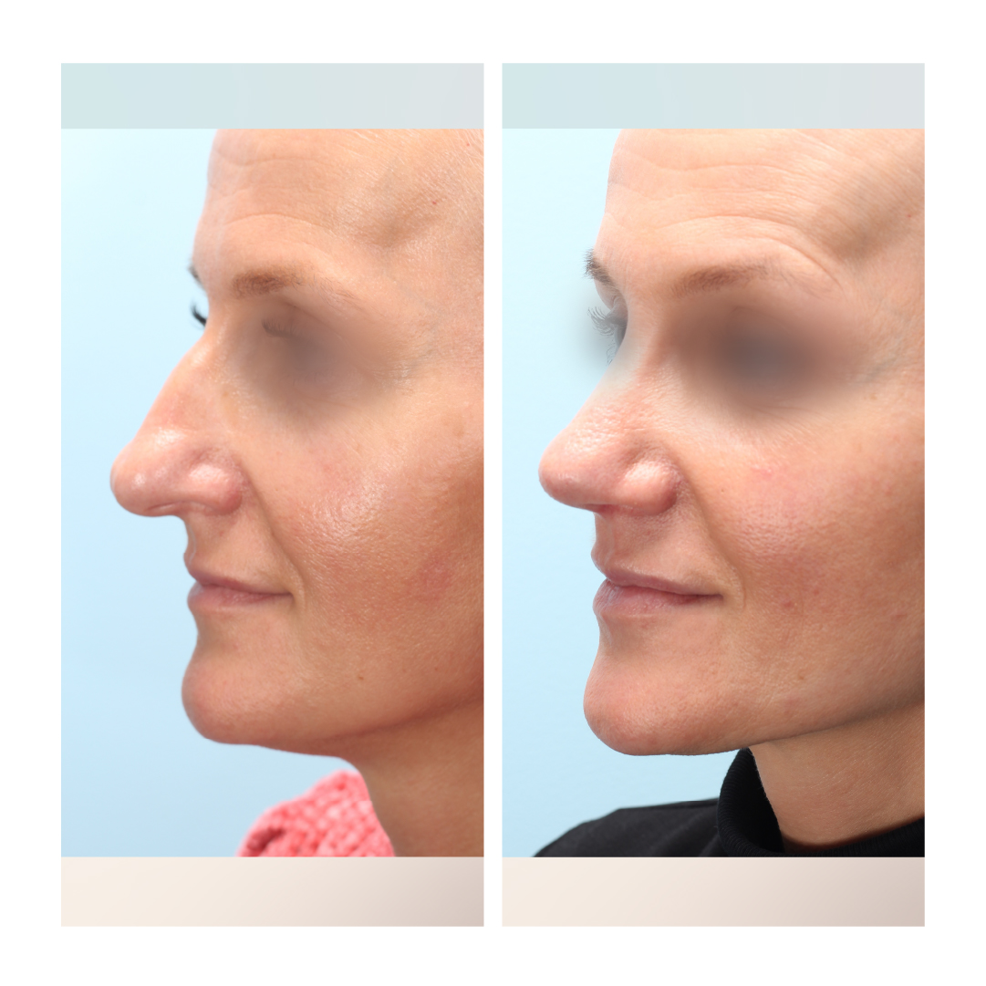 Face Surgeries- fi clinica
