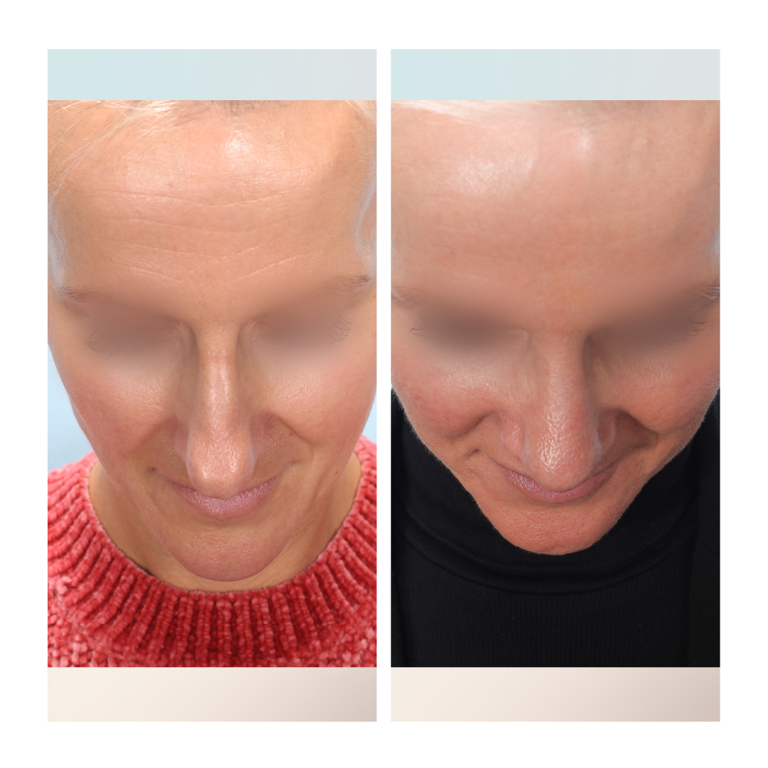 Face Surgeries- fi clinica