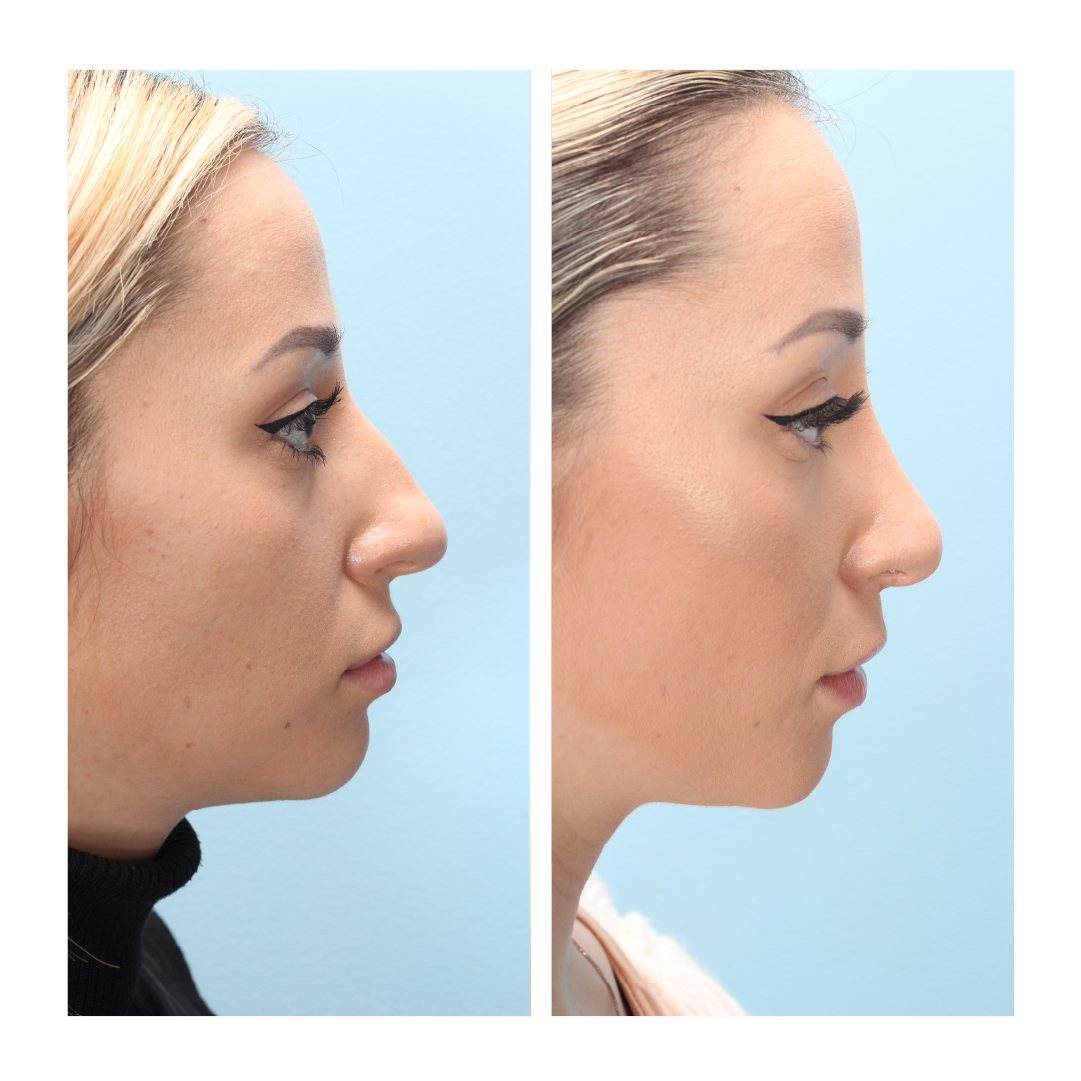 Face Surgeries- fi clinica